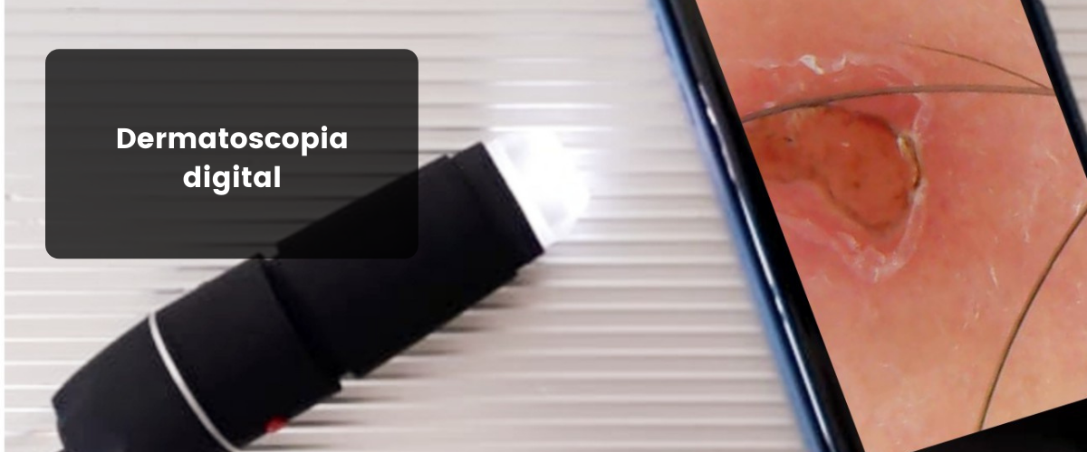 Dermatoscopia