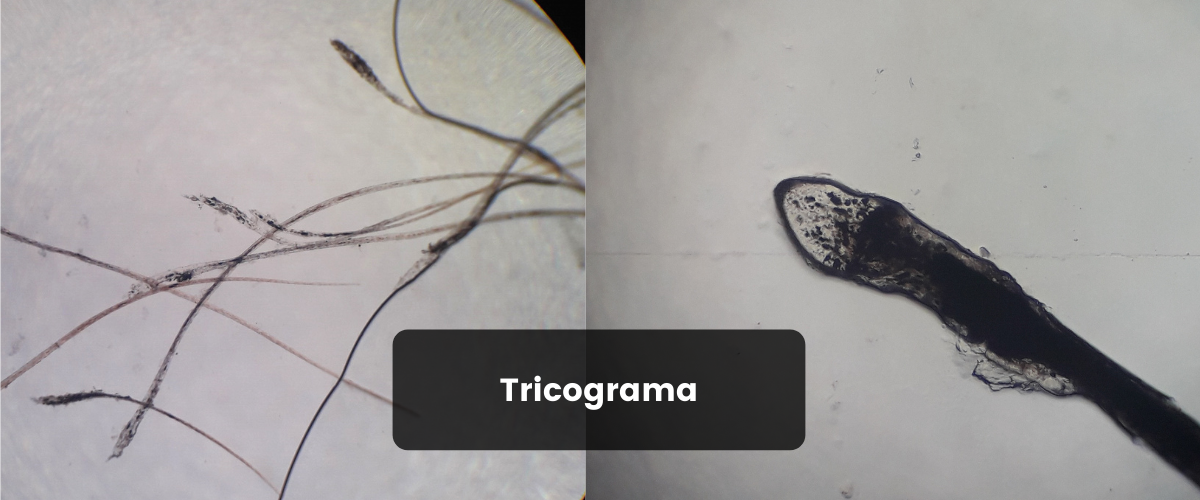 Exame de tricografia